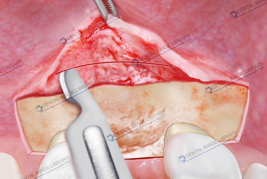 Harvesting Epithelial-Connective tissue graft from palate. Collection ...