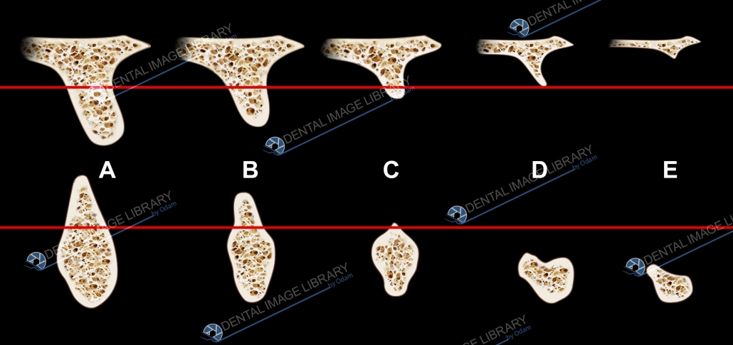 Classification of the host bone by Lekholm and Zarb. 103JB00003 ...
