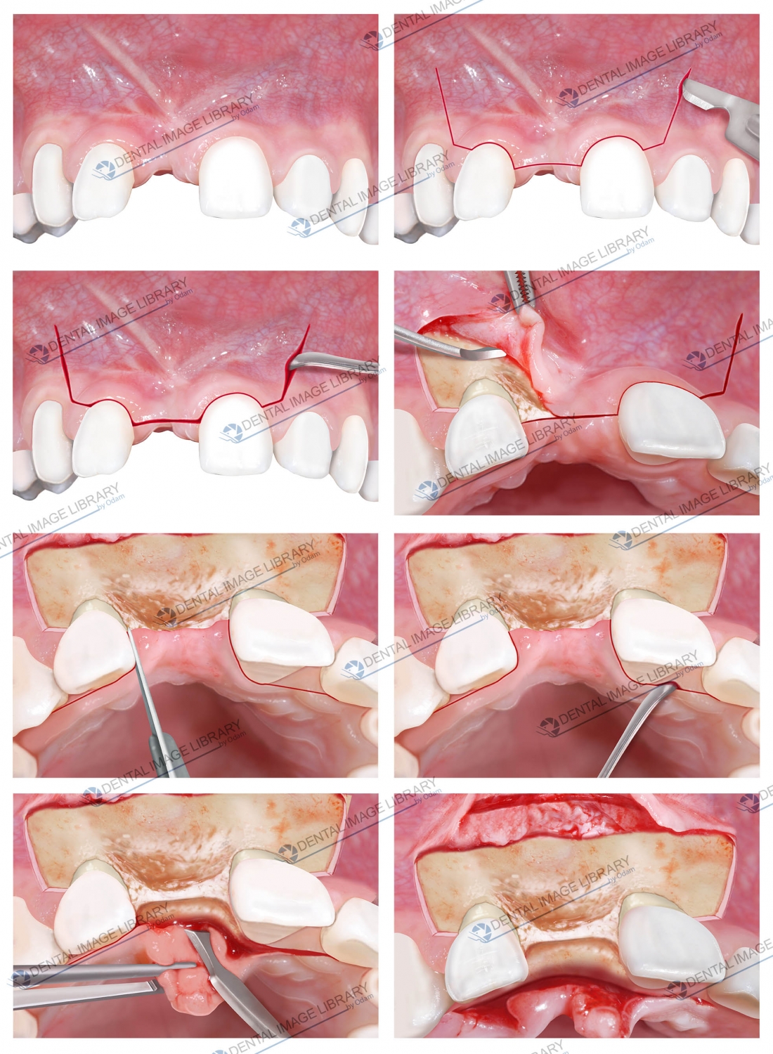 Collection step-by-step illustrations. Buccal and palatal flap design ...