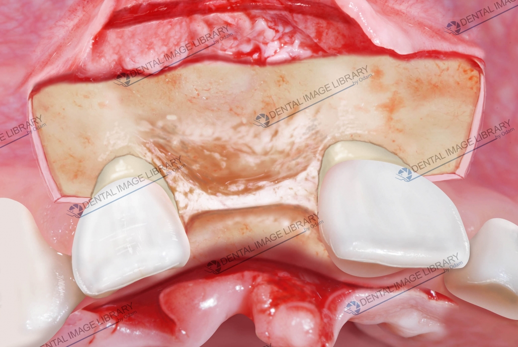 Occlusal view of the anterior maxillary sextant with horizontal tissue ...
