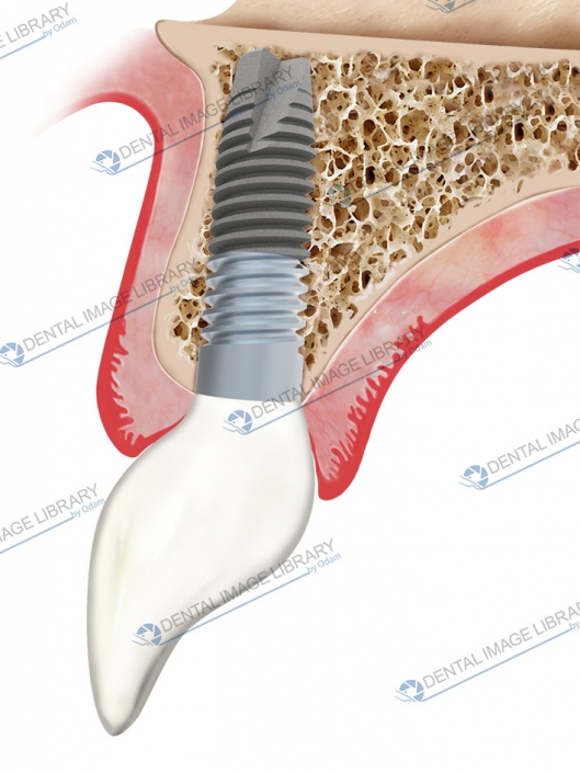 Buccal-lingual angle of implant position in esthetic areas. 61JW00002 ...