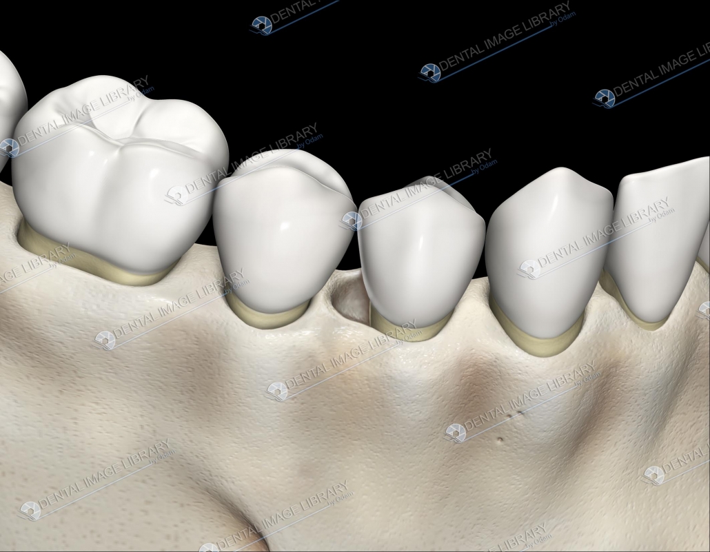Three wall intrabony defect. 102JB00057 | Dental Image Library