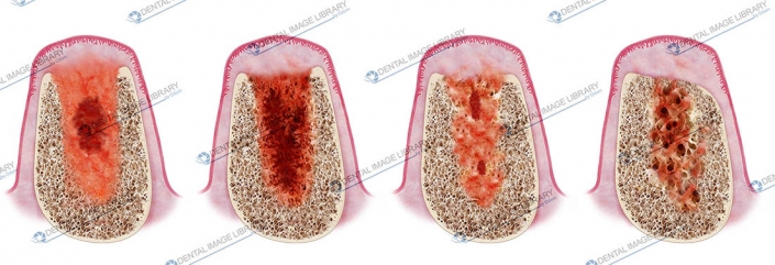 Healing of the extraction socket. 102JW00040 | Dental Image Library