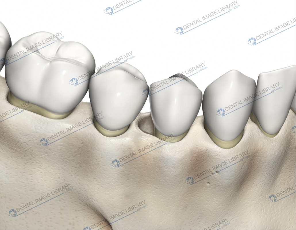 Three wall intrabony defect. 102JW00056 | Dental Image Library