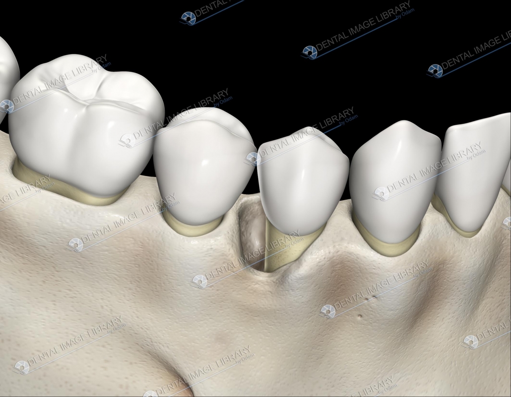 Two wall intrabony defect. 102PN00051 | Dental Image Library