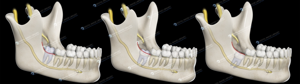 Pell and Gregory classification: Relationship with the mandibular ramus ...