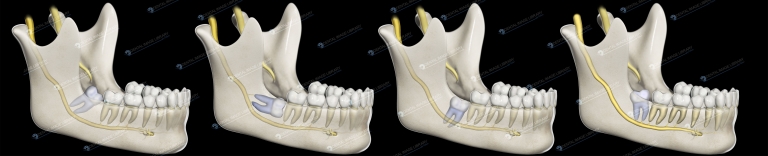 Winter’s classification. 12JB00033 | Dental Image Library