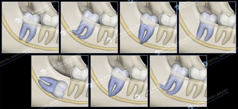 Classification of the third molar in relation to inferior alveolar ...
