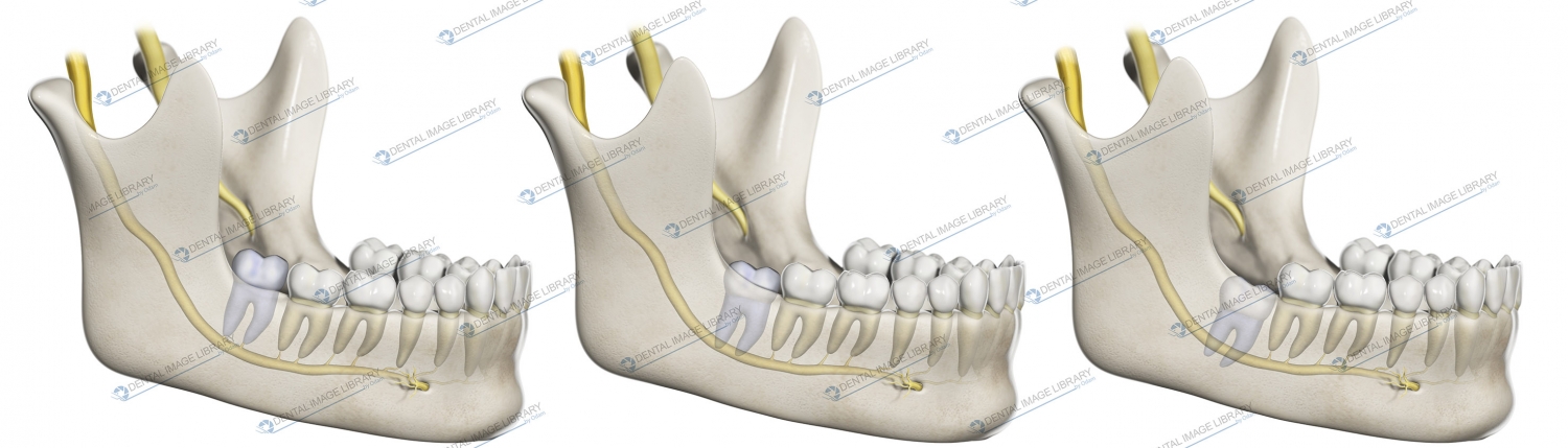 Pell and Gregory classification: relation of the cementoenamel junction ...