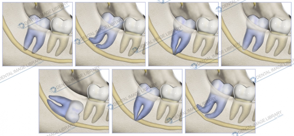 Classification of the third molar in relation to inferior alveolar ...