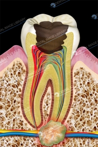 Root abscess in inferior molar. 42JB00002 | Dental Image Library