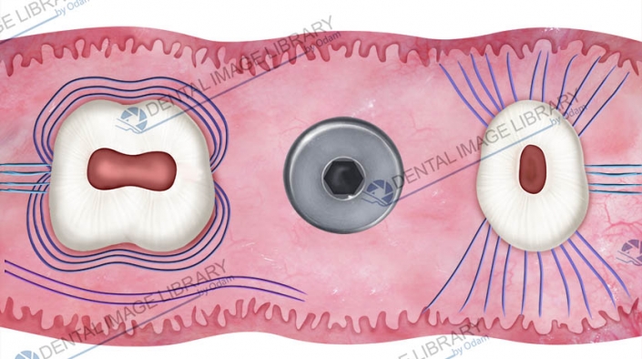 Modified roll flap technique step by step. Black background. | Dental ...