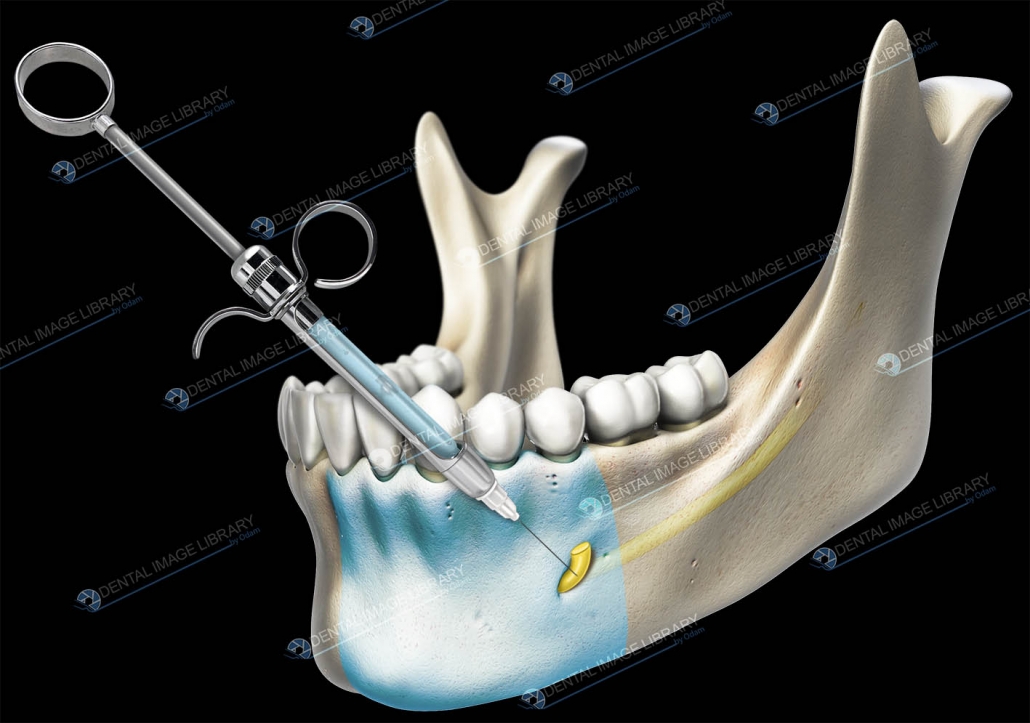 Dental Anesthesia: mental nerve block. 82JB00001 | Dental Image Library