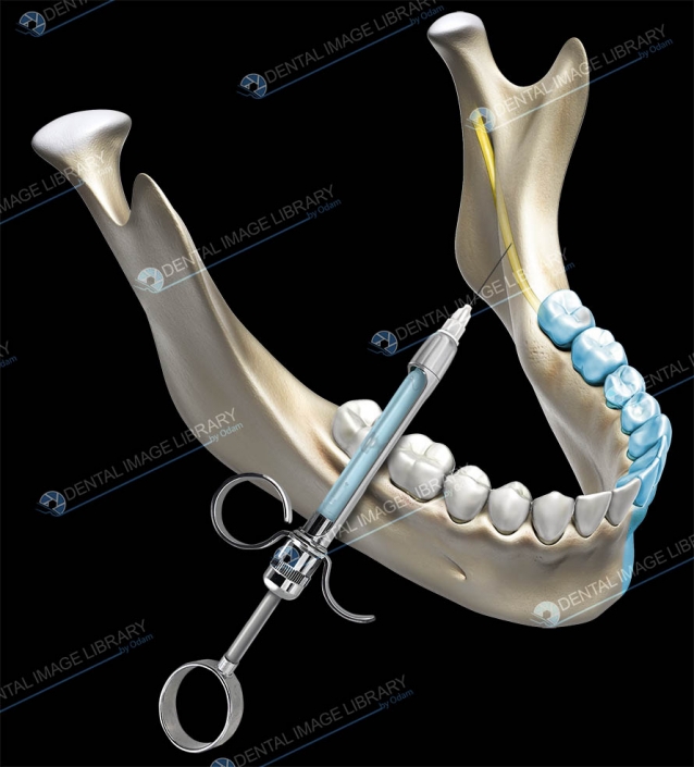 Dental Anesthesia: inferior alveolar nerve block. 82JB00004 | Dental ...