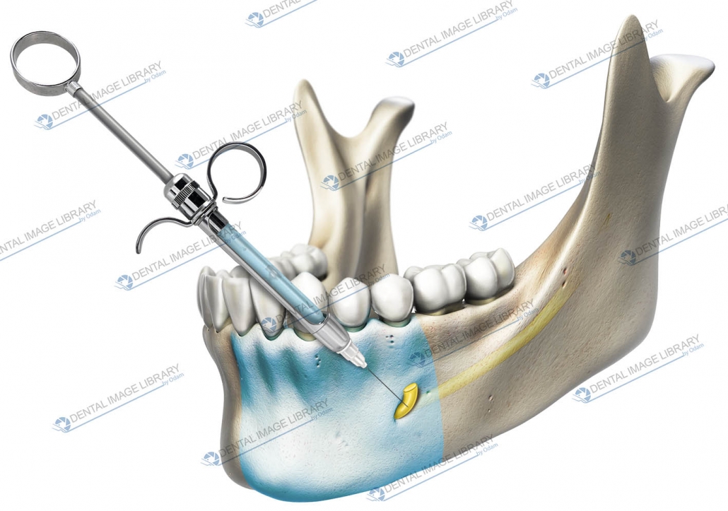 Dental Anesthesia: mental nerve block. 82JW00002 | Dental Image Library
