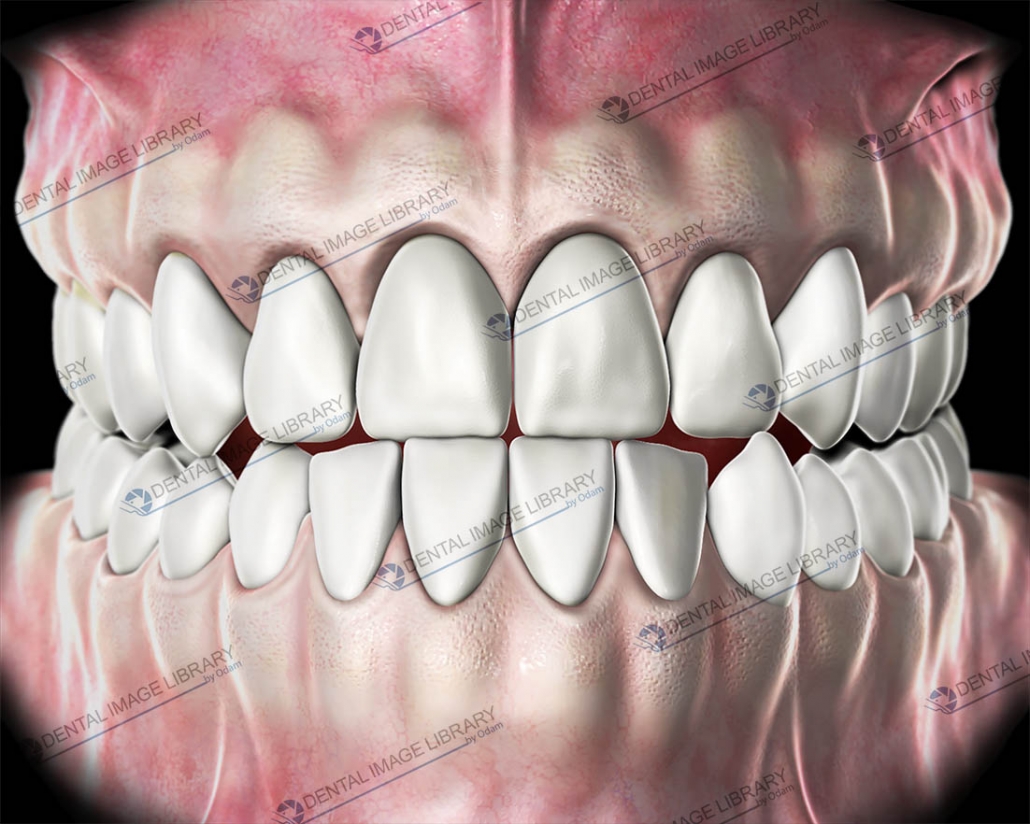Class 3 malocclusion. Overly crowded. Frontal view. 93JB00017 | Dental ...