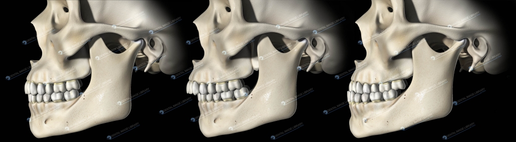 Three types of malocclusion: class 1, class 2 and class 3. 93JB00019 ...