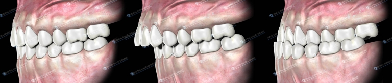 Three types of malocclusion: class 1, class 2 and class 3. 93JB00021 ...