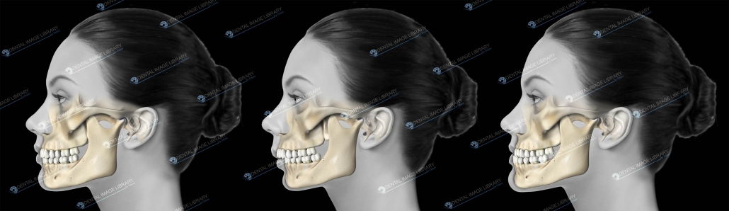 Three types of malocclusion: class 1, class 2 and class 3. 93JB00025 ...
