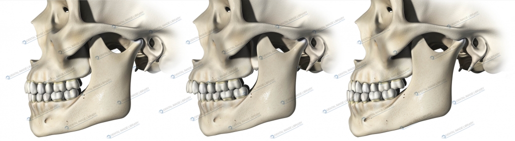 Three types of malocclusion: class 1, class 2 and class 3. 93JW00020 ...