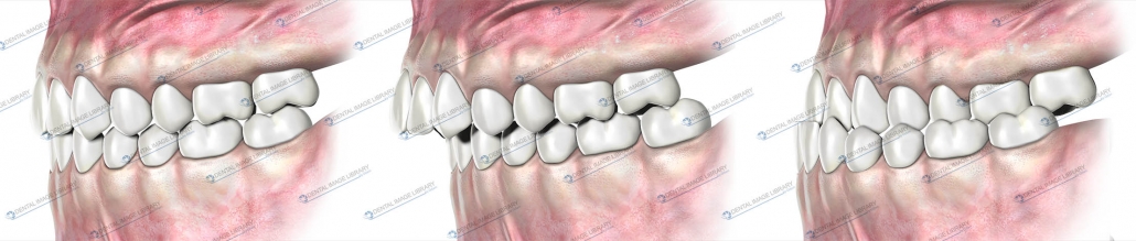 Three types of malocclusion: class 1, class 2 and class. 93JW00022 ...