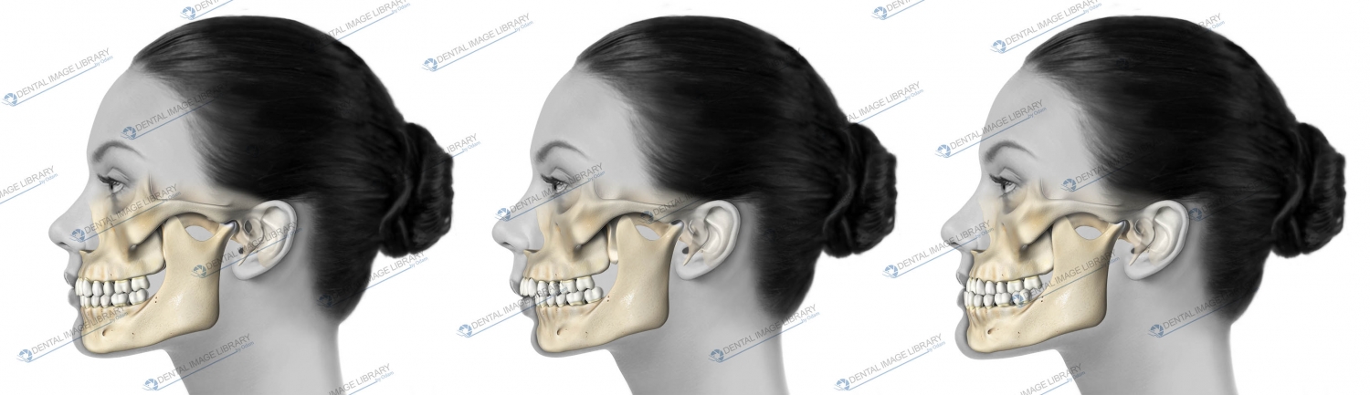 Three types of malocclusion: class 1, class 2 and class 3. 93JW00024 ...