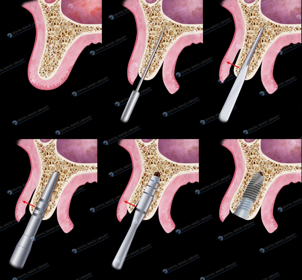 Collection of 6 illustrations. Split ridge technique illustrated step ...