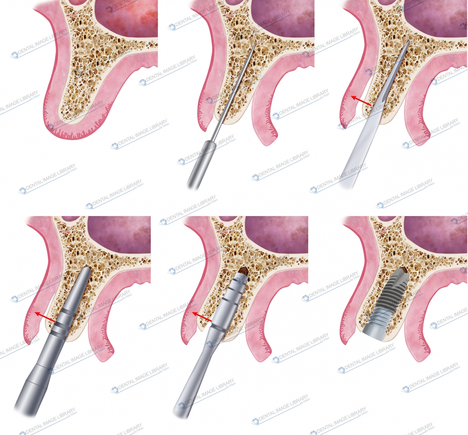 Ridge Split technique illustrated step-by-step. Collection of 6 ...