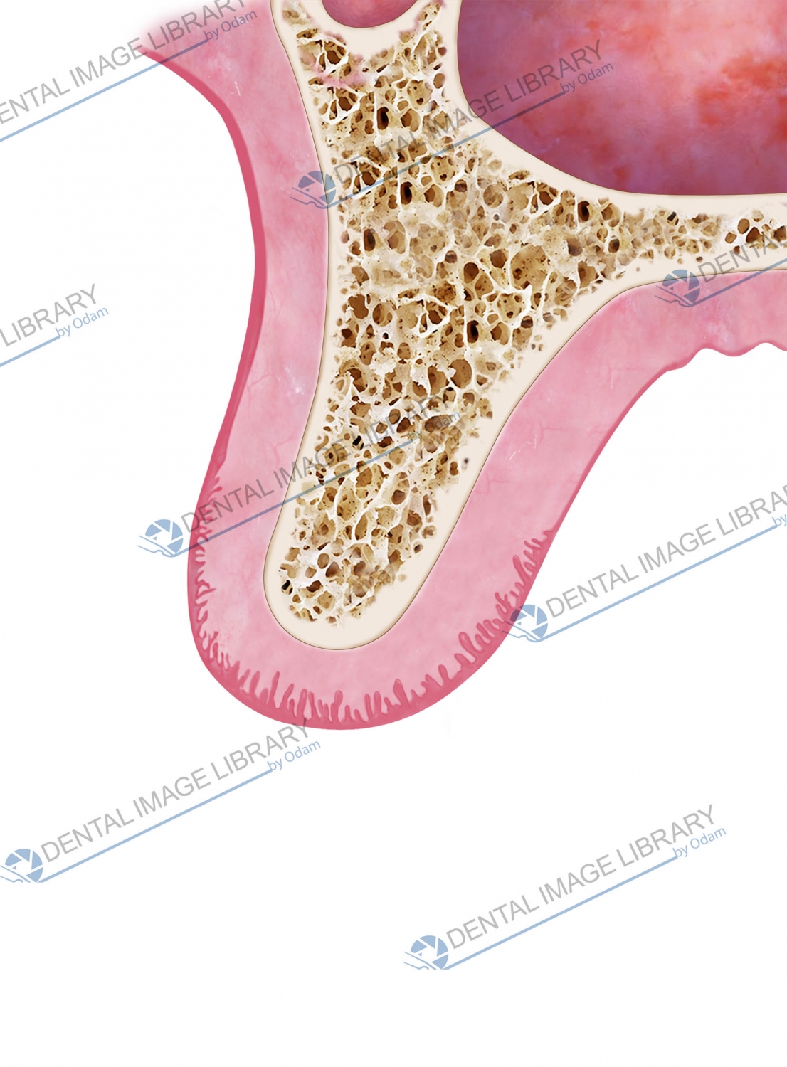 Sagittal section of maxilla with knife-edge alveolar bone morphology ...