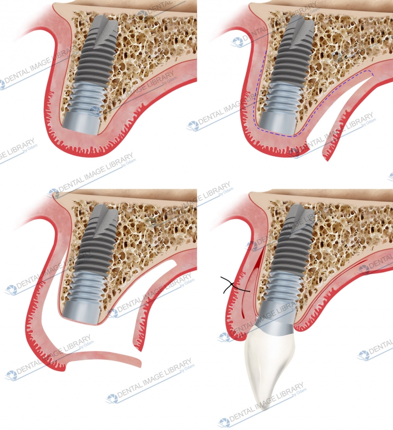 Modified roll flap technique step by step. White background. | Dental ...