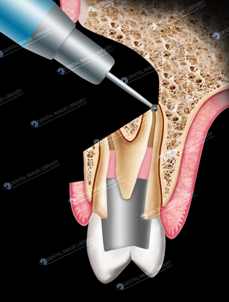 Surgical access through the cortical bone to the roots of maxillary ...