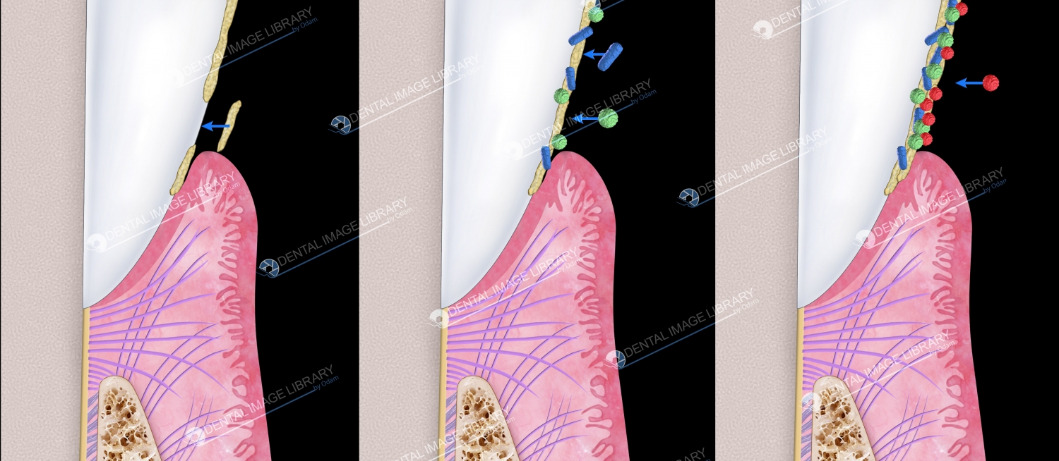 Stages of microbial plaque formation. 32JB00003 | Dental Image Library