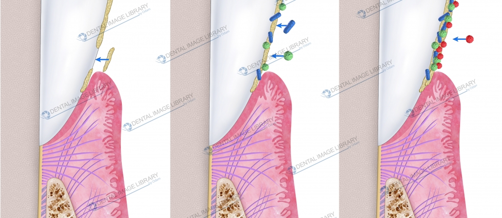 Stages of microbial plaque formation. 32JW00002 | Dental Image Library