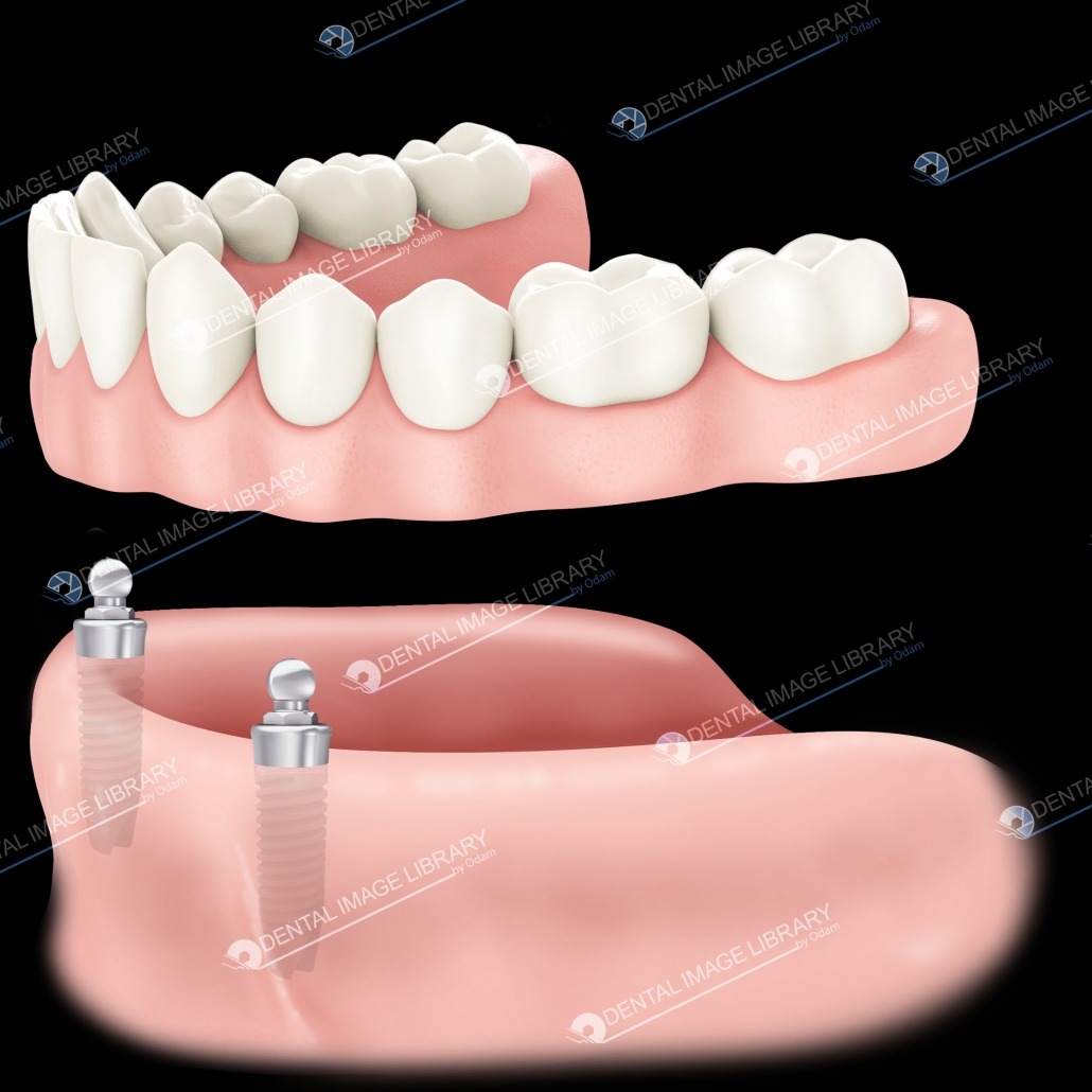 Fixed-removable denture. 62JB00113 | Dental Image Library
