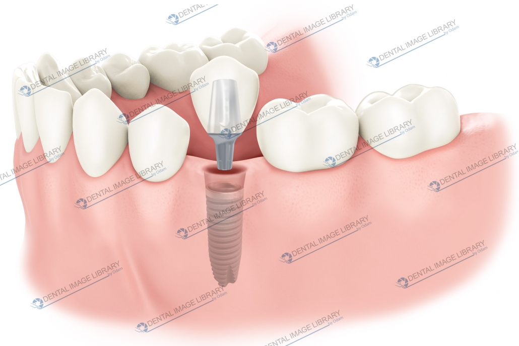 Single screw-retained crown. 62JW00106 | Dental Image Library