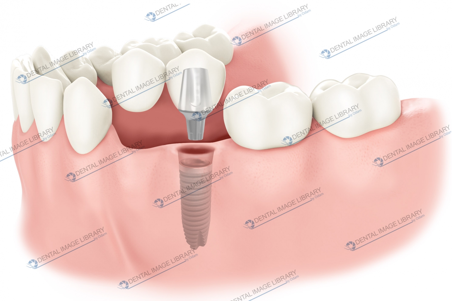 Unit screw retained bridge. 62JW00108 | Dental Image Library