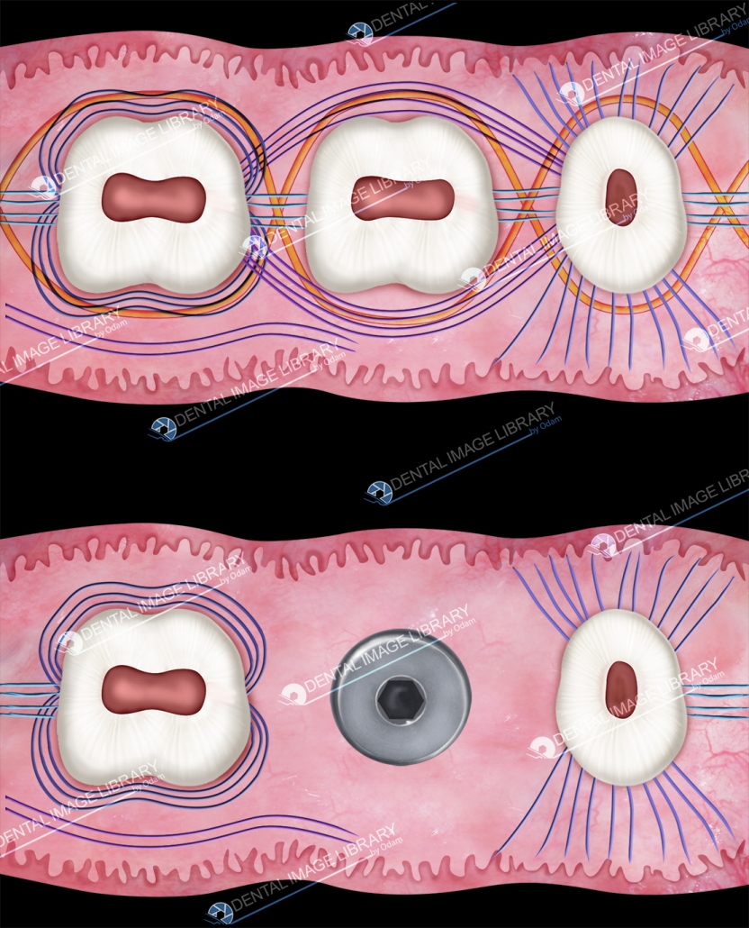 Collection of two drawings: teeth gingival fibers vs peri-implant ...