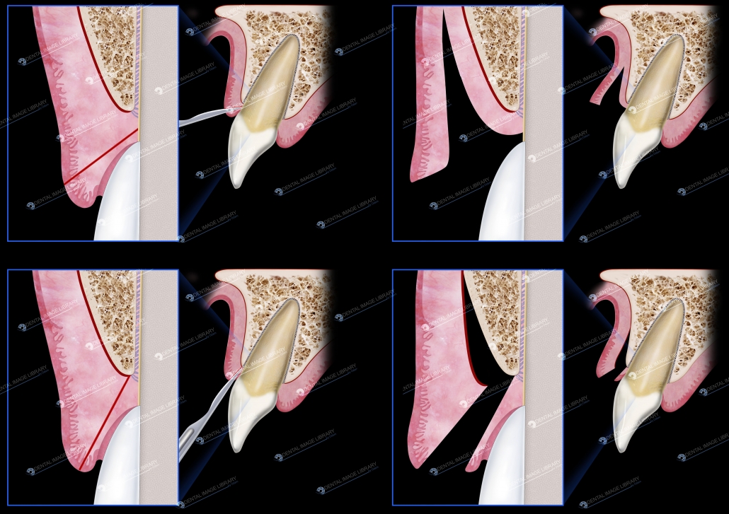 Collection of four images: partial-thickness flaps (mucosal) and flap ...