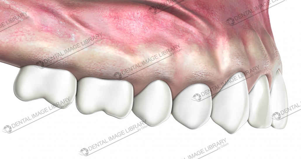 Lateral view of upper teeth with gums. 11JW00081 | Dental Image Library