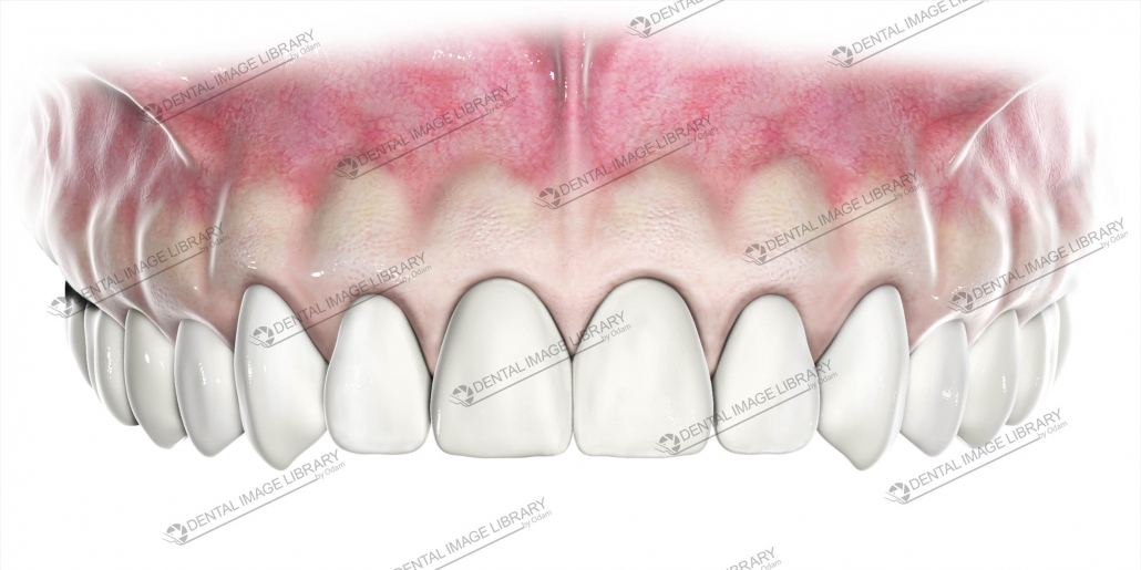Occlusal view of upper teeth with gum. 11JB00091 | Dental Image Library