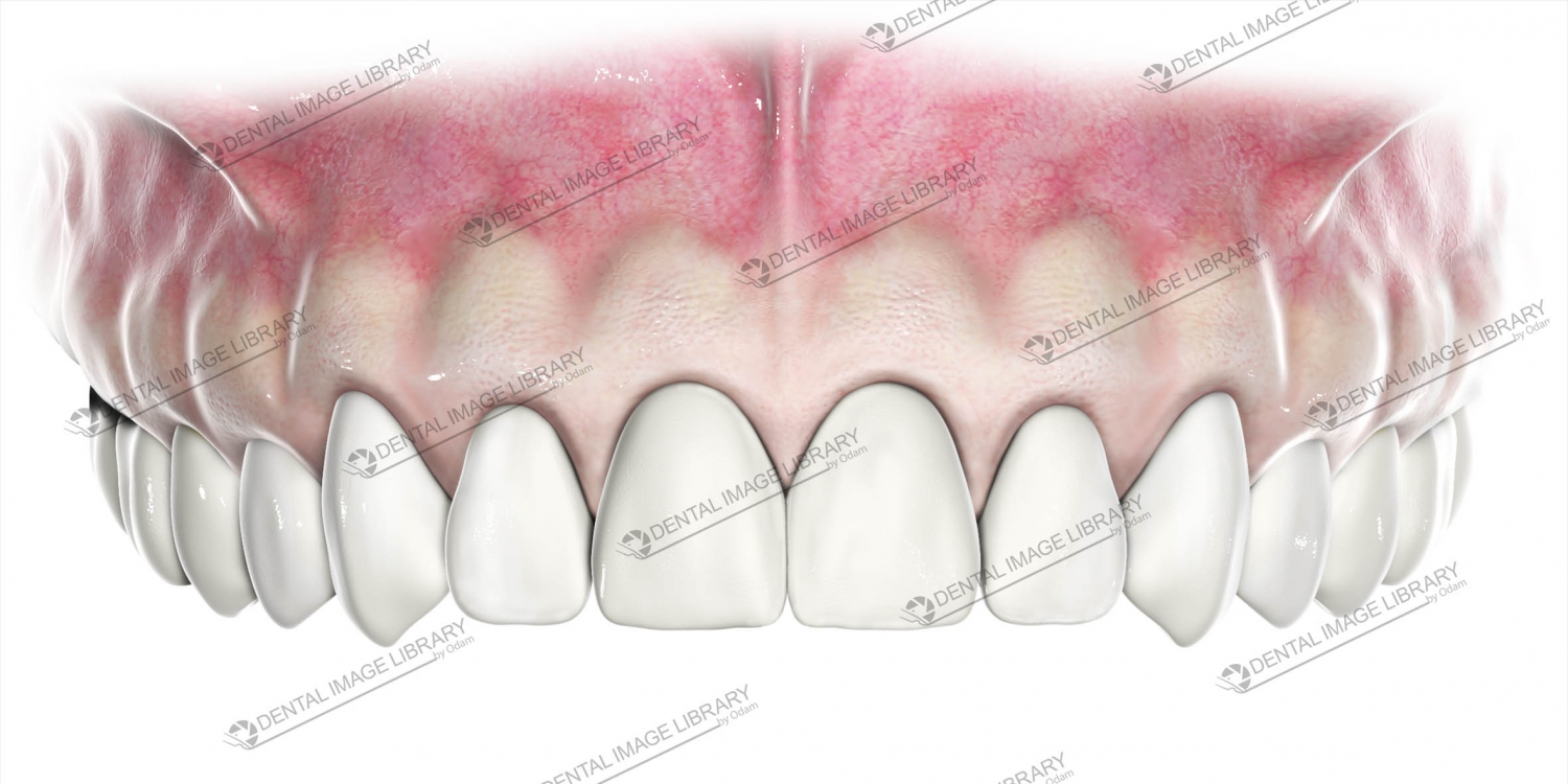 Frontal view of upper teeth with gum. 11JW00083 | Dental Image Library