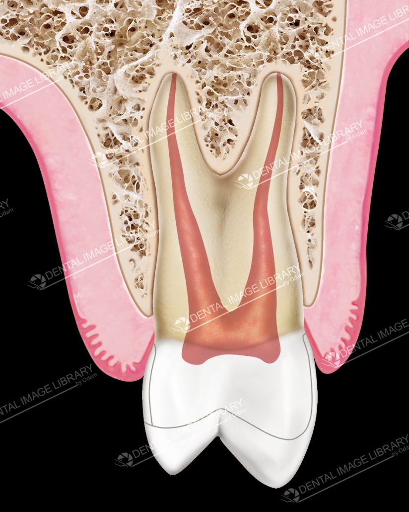 Veneer on maxillary first premolar. 21JB00017 | Dental Image Library