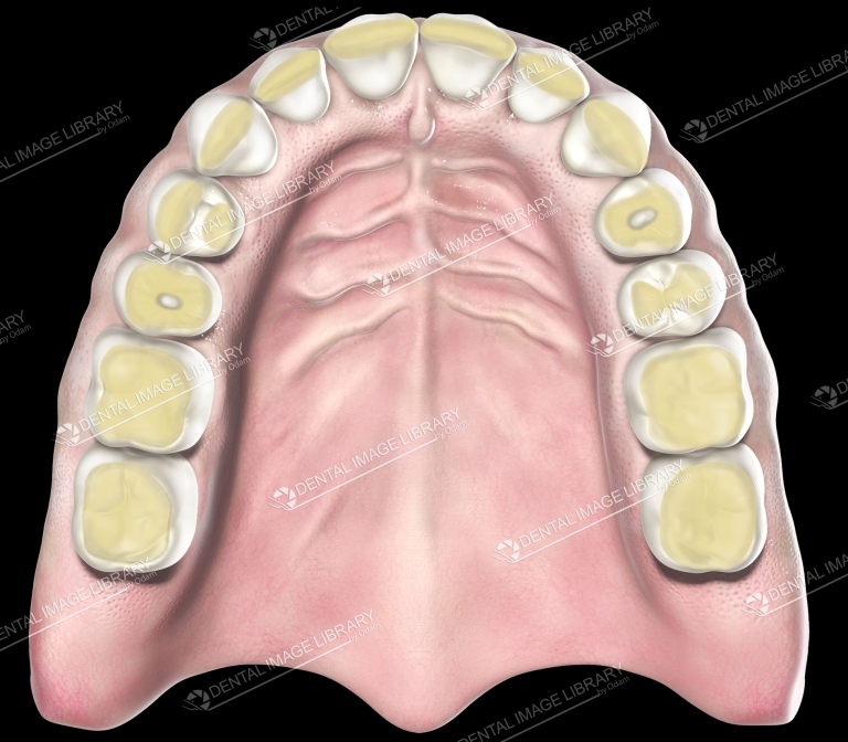 Occlusal view of worn upper teeth. 21JB00021 | Dental Image Library