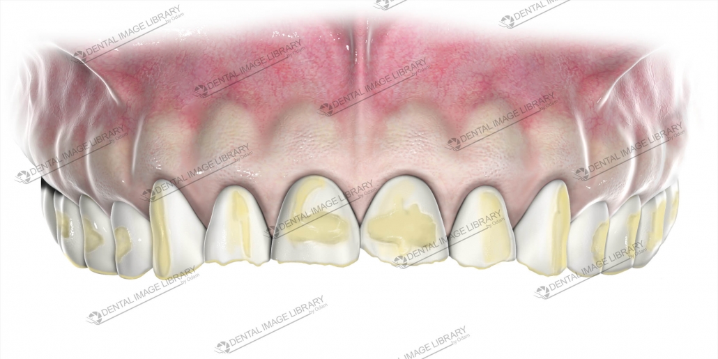 Frontal view of upper worn teeth. 21JW00009 | Dental Image Library