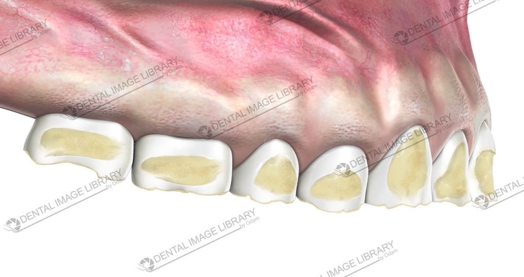 Lateral view of worn upper teeth. 21JW00012 | Dental Image Library