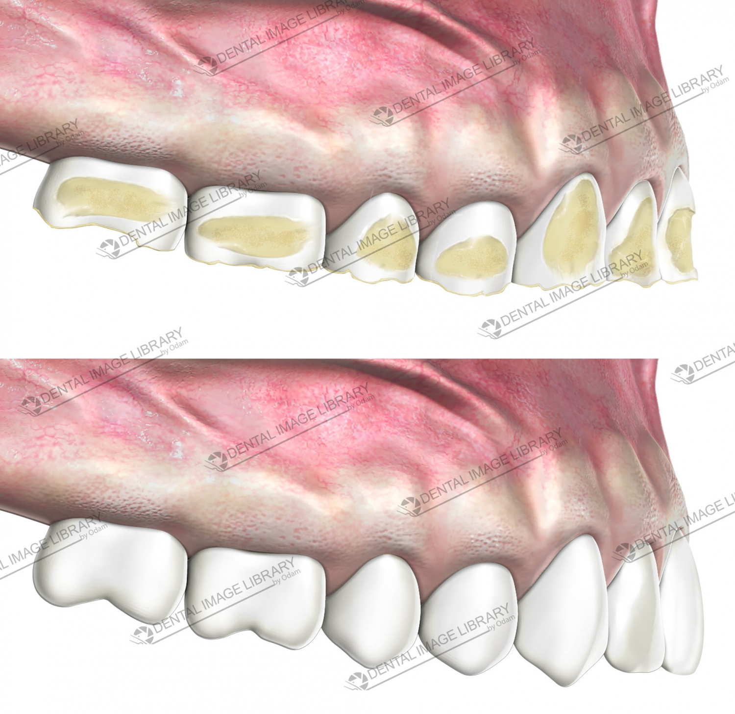 Frontal and lateral view of upper wear teeth. Collection of two images ...