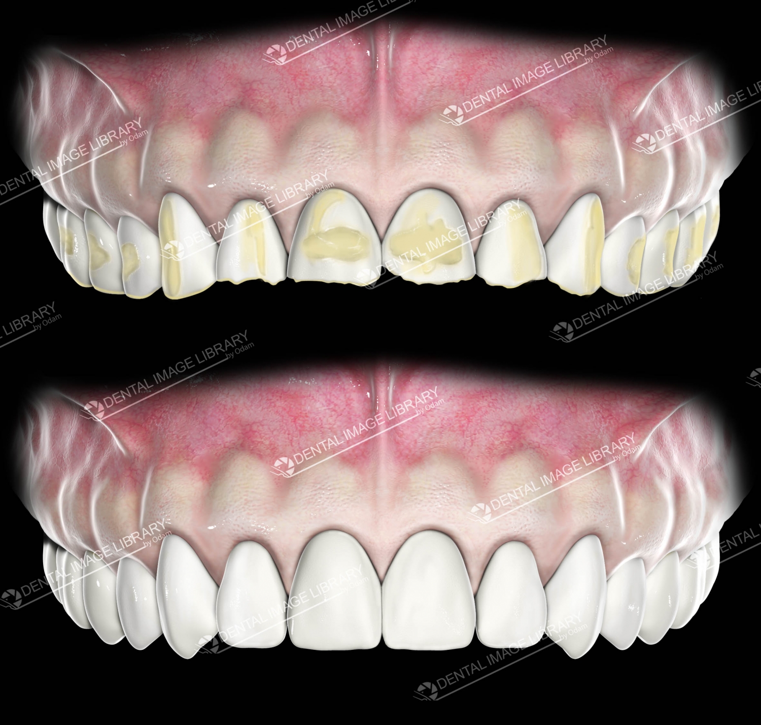 Treatment of upper worn teeth. Occlusal view. Collection of two images ...
