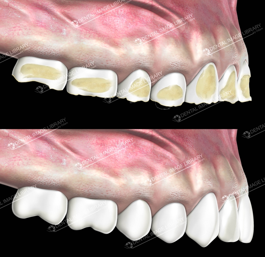 Lateral view of upper wear teeth. Collection of two images. | Dental ...