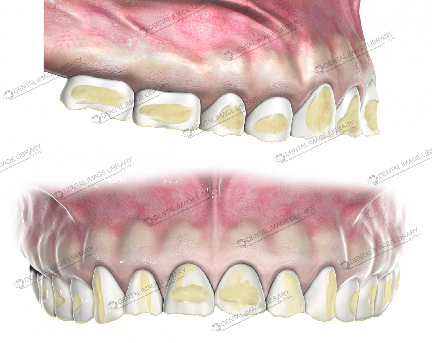 Treatment of upper worn teeth. Occlusal view. Collection of two images ...