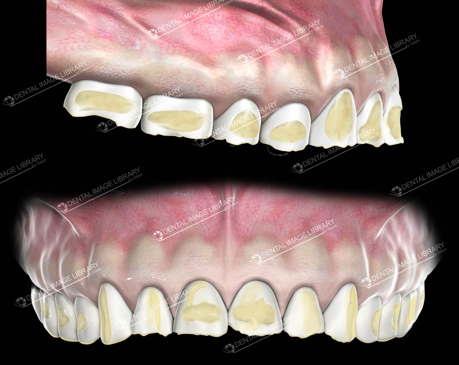 Frontal and lateral view of upper wear teeth. Collection of two images ...